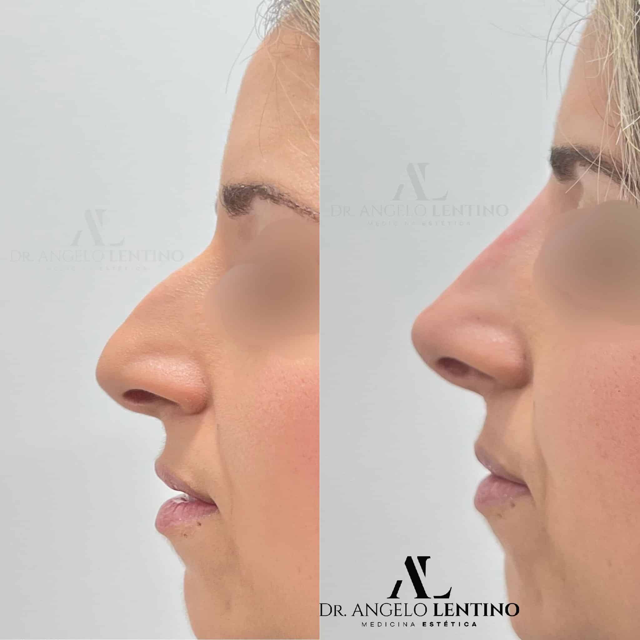 Rinomodelación sin cirugía en Vigo | Lemont Clinic