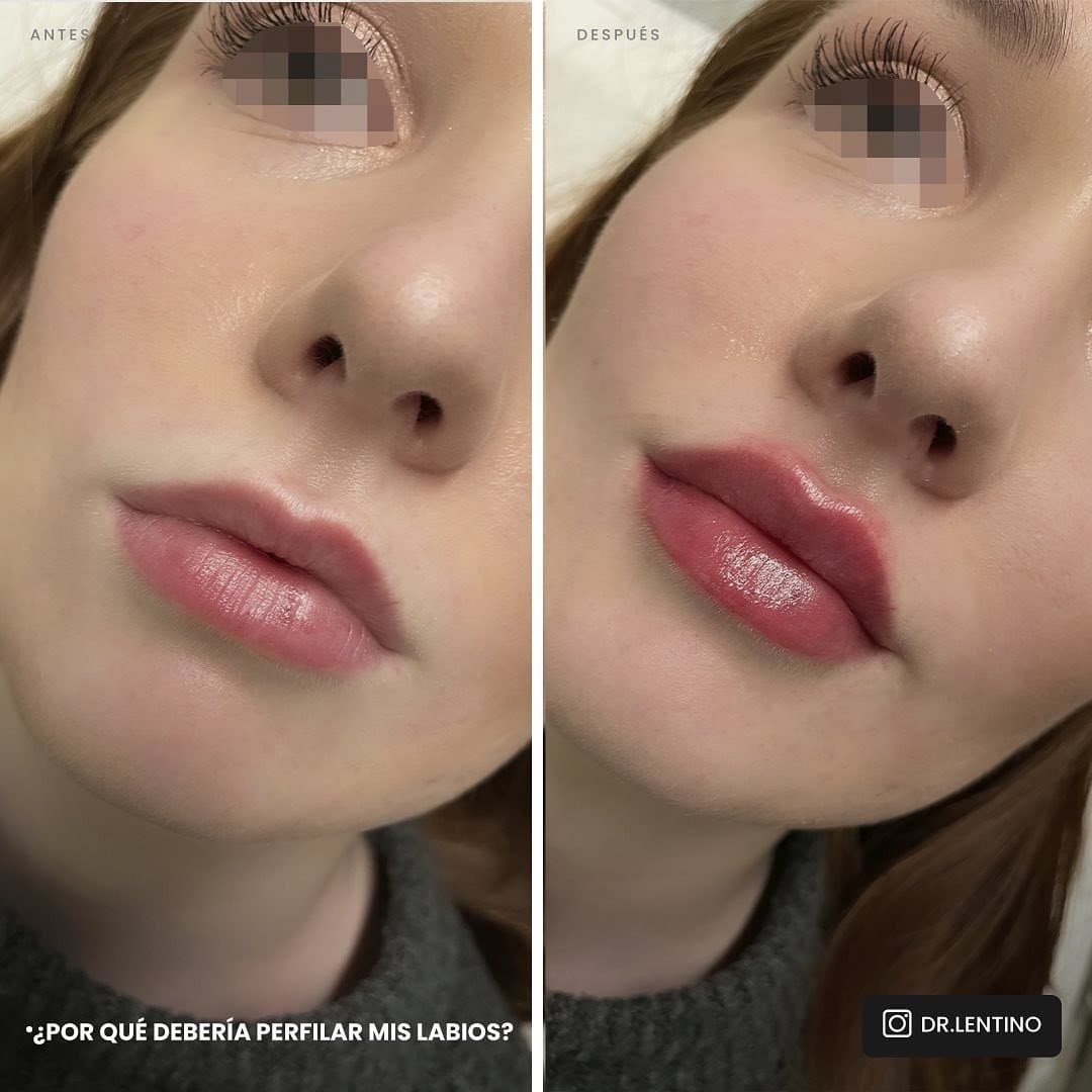 Diseño y aumento de labios con ácido hialurónico | Lemont Clinic