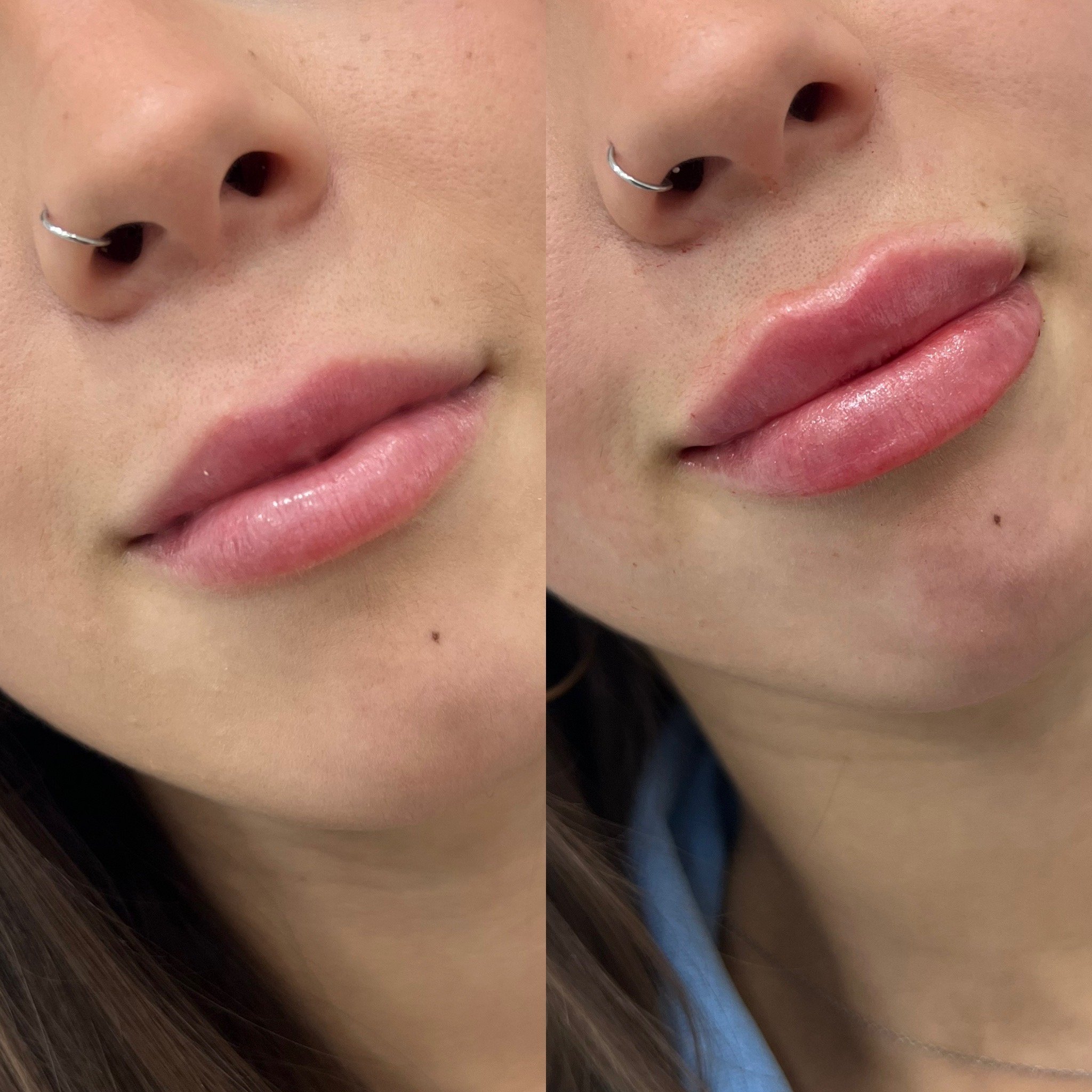 Diseño y aumento de labios con ácido hialurónico | Lemont Clinic